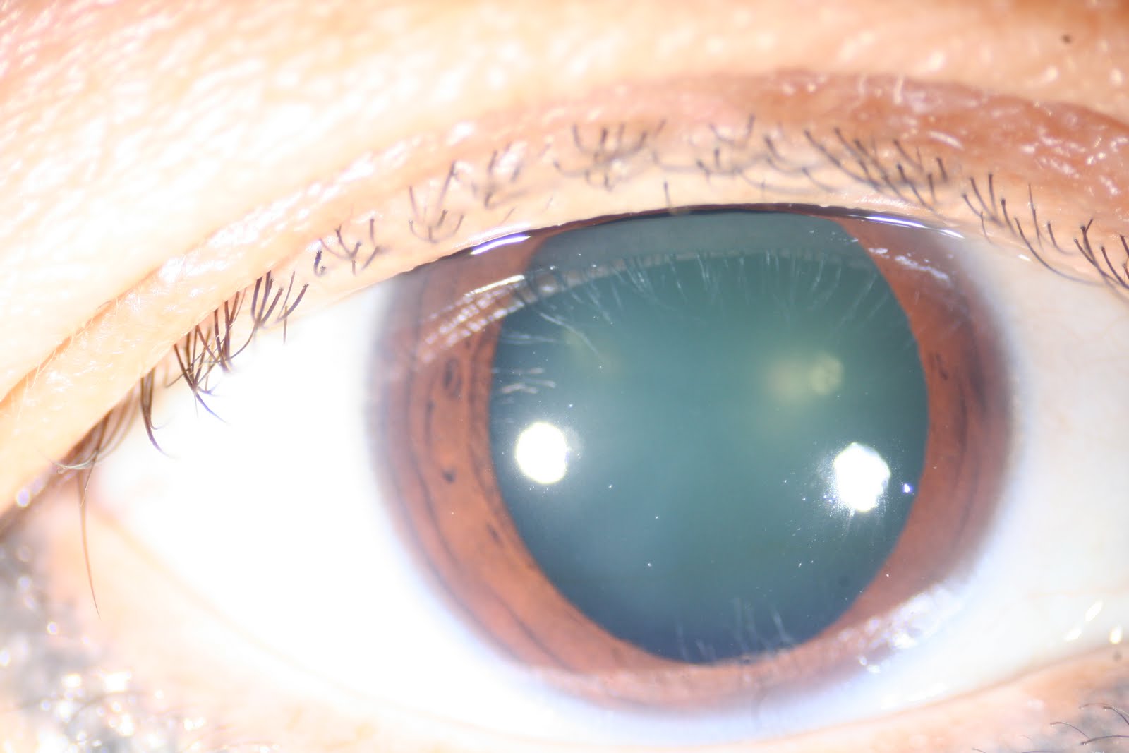 Eye Mydriasis Definition at Jett Boyer blog