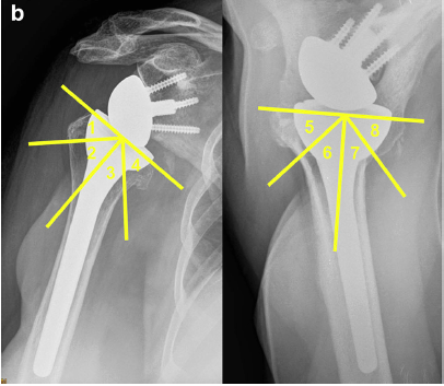 Shoulder Arthritis/Joint Replacement Rotator cuff tears: Stemless ...