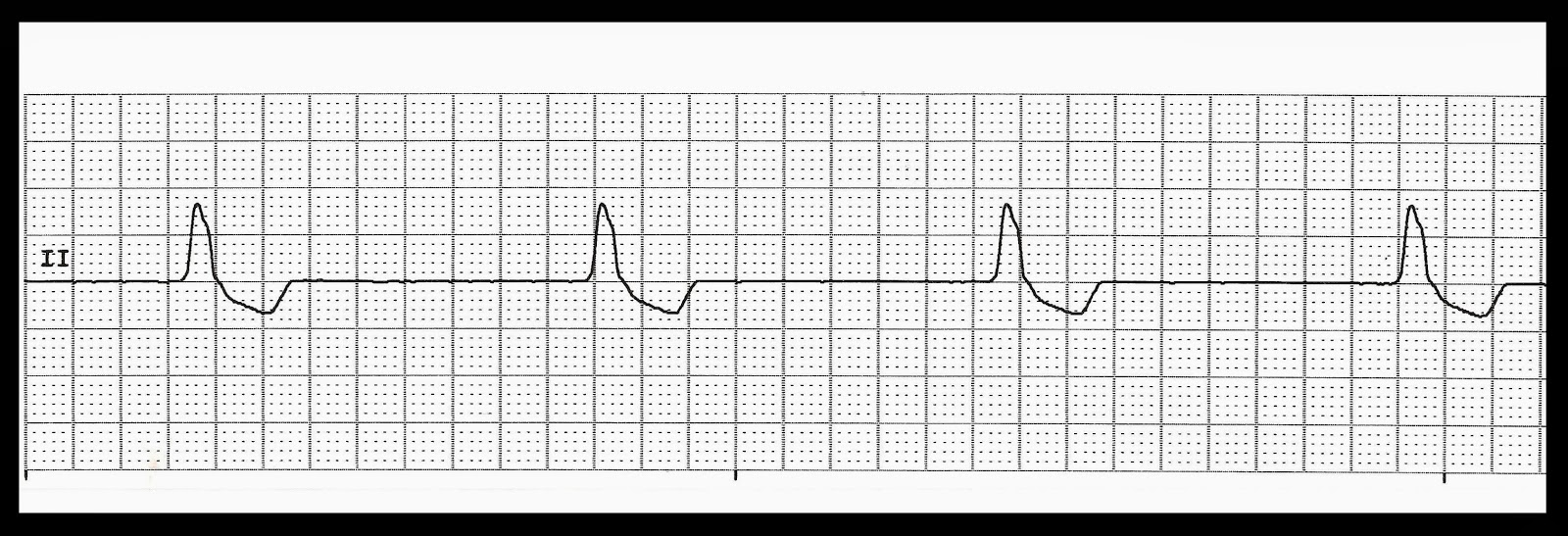 Float Nurse: Various Idioventricular Rhythms