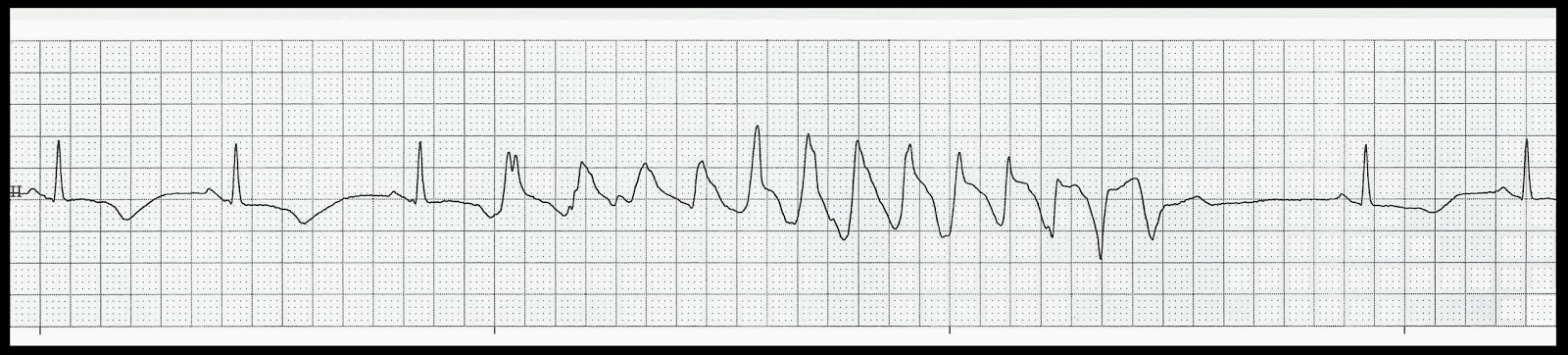 EKG Rhythm Strip Quiz 213
