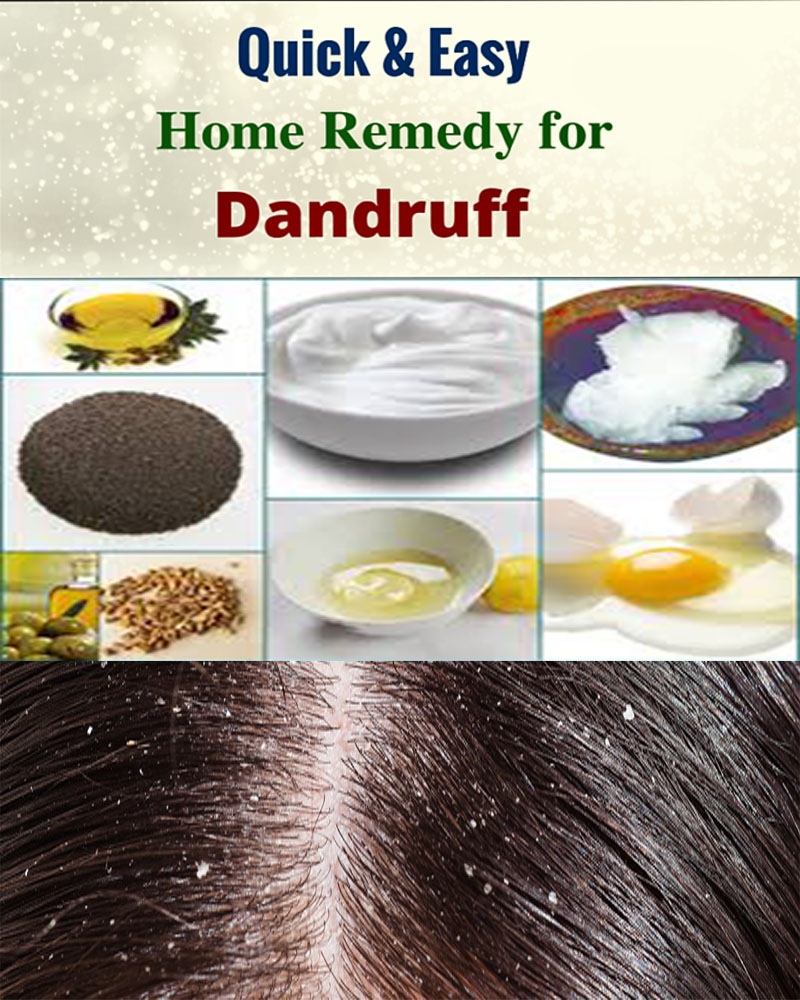 Dandruff Remedy at Home ~ Bye Bye dandruff