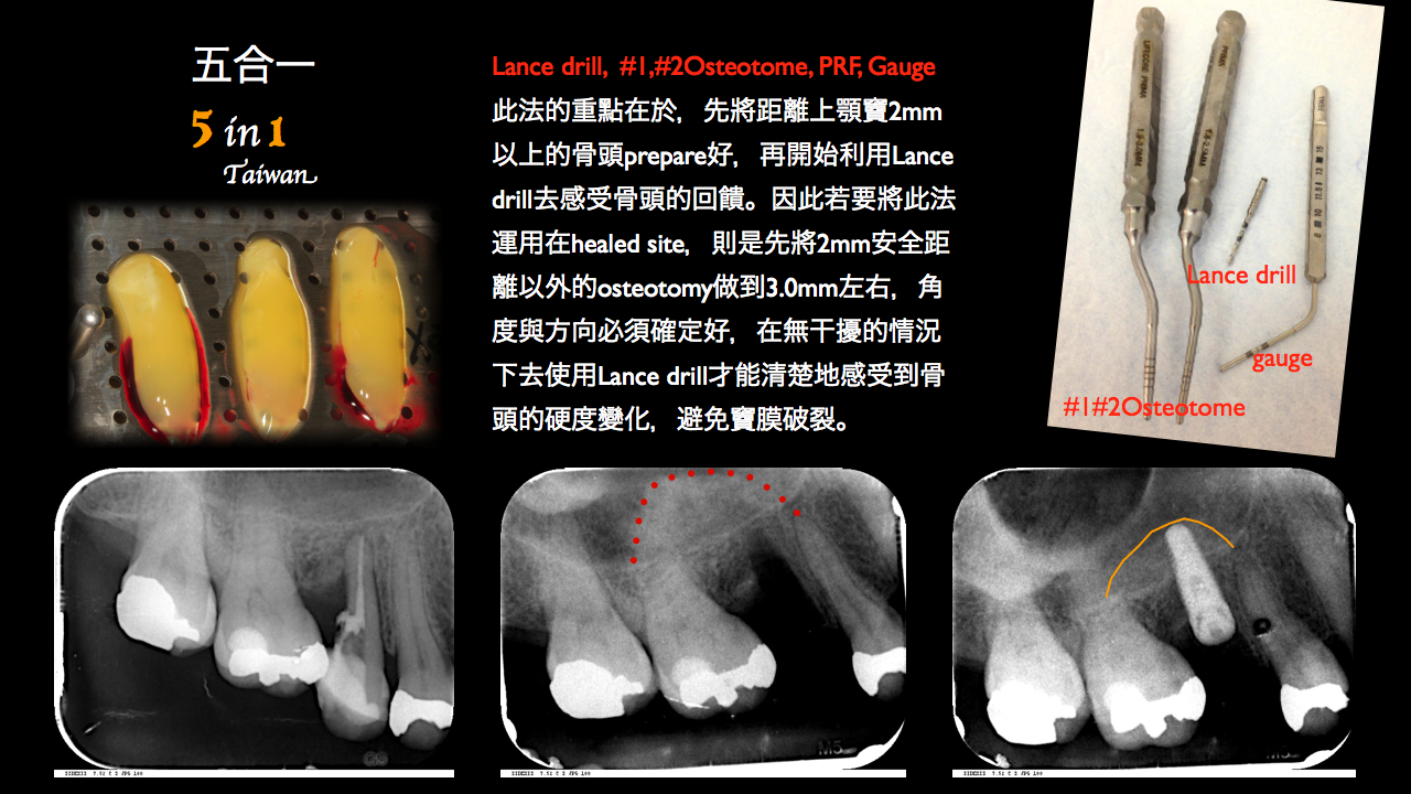 ・城東牙醫_陳政佑醫師・部落格: 立即植牙合併齒脊法上顎竇增高術 immediate implantation with osteotome ...