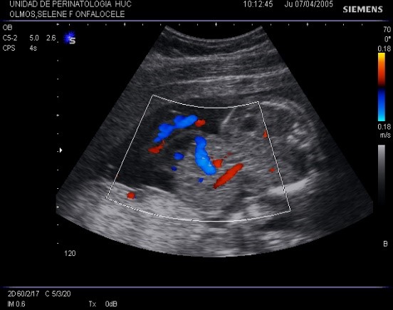 Gastrosquisis y Onfalocele, malformaciones frecuentes de la pared ...