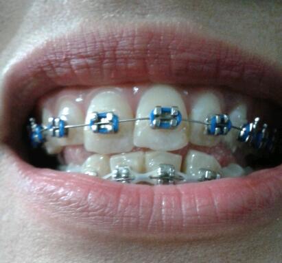getah braces warna biru - Stephen Randall