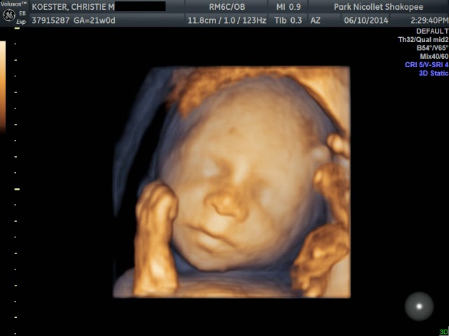20 Week Level II Ultrasound - Baby #2 ~ Christie Koester