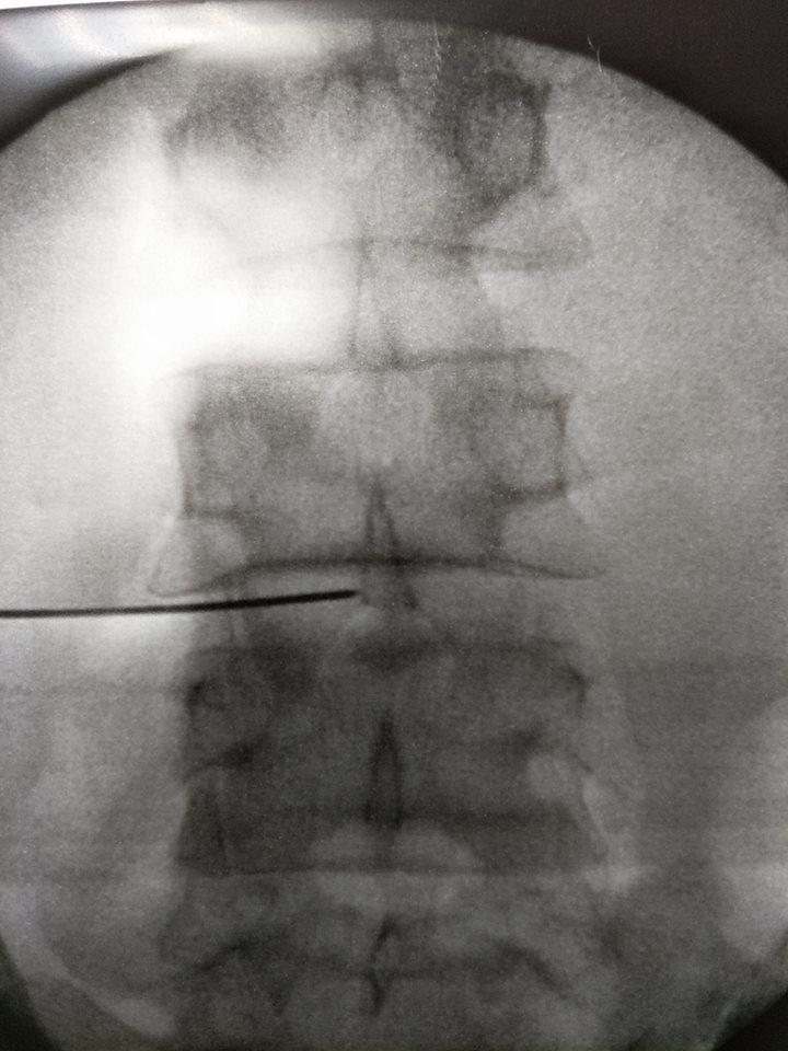Kesakitan Anda Keutamaan Kami: Injection laser PLDD for lumbar slipped ...