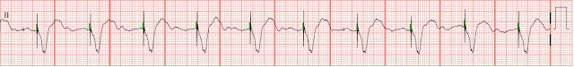 EKG Rhythm Strips 22: Paced Rhythms