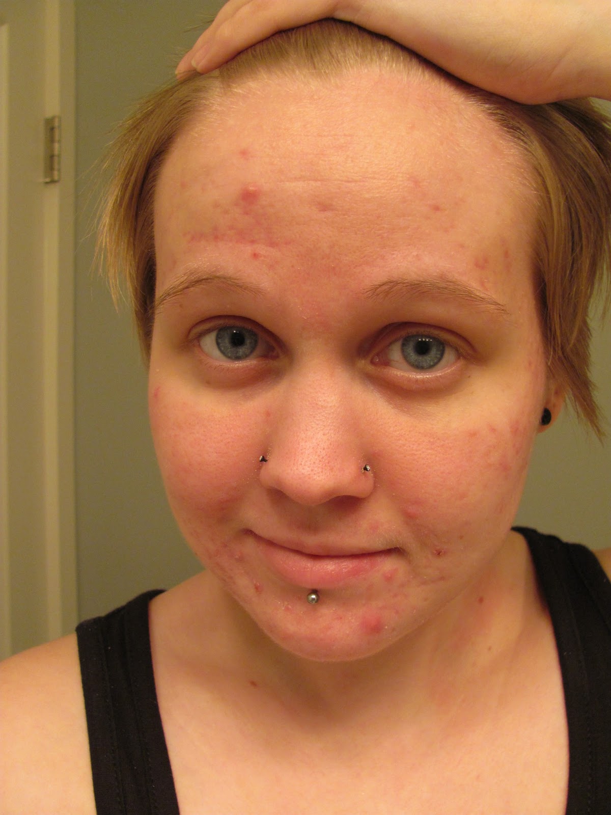 Writings and Rants: The First Month of Accutane In Pictures