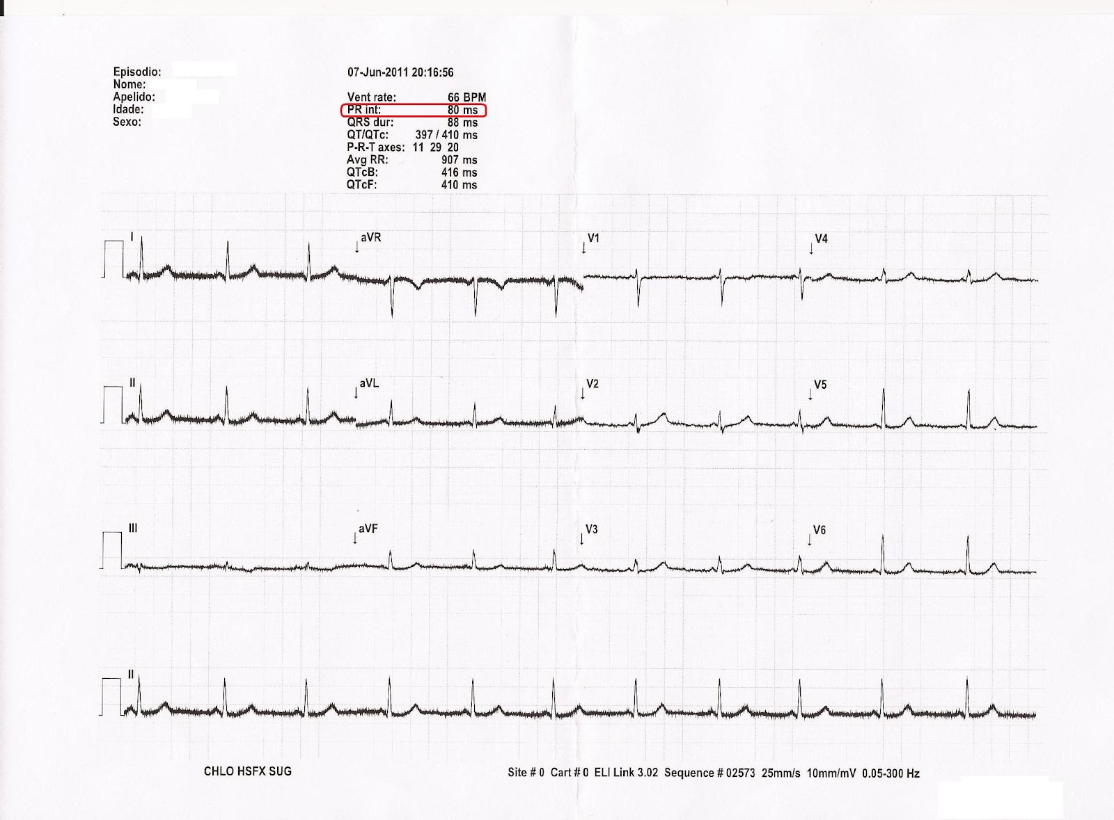 Cardiopneumologia: Suspeita de Síndrome Lown-Ganong-Levine (LGL)