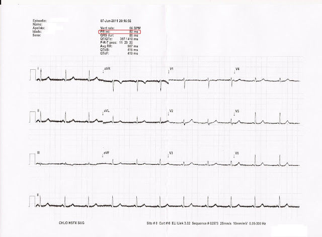 Cardiopneumologia: Suspeita de Síndrome Lown-Ganong-Levine (LGL)