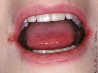 Clinica Dentaria Mais Sorriso: Queilite Angular: O que é e quais as causas?