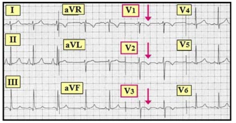 ECG Interpretation: ECG Interpretation Review #28 (ST-T Wave Changes ...