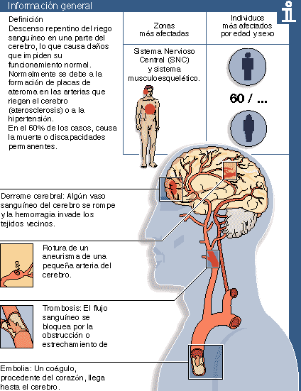 HIPERTENSIÓN ARTERIAL: COMPLICACIONES HTA