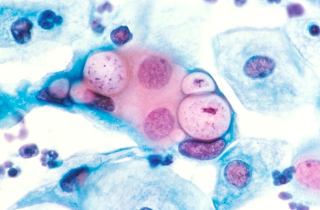 Pap Smear : Definition, Process, Prevention And Warning - ReadNews