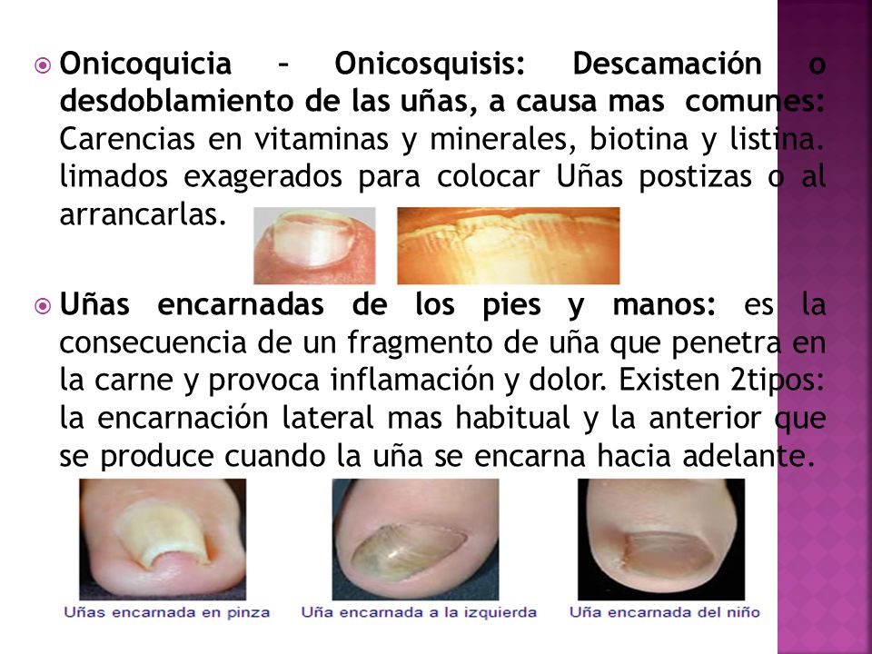 Art Design by Nails: Onicoquicia-Onicosquisis y Uñas encarnadas