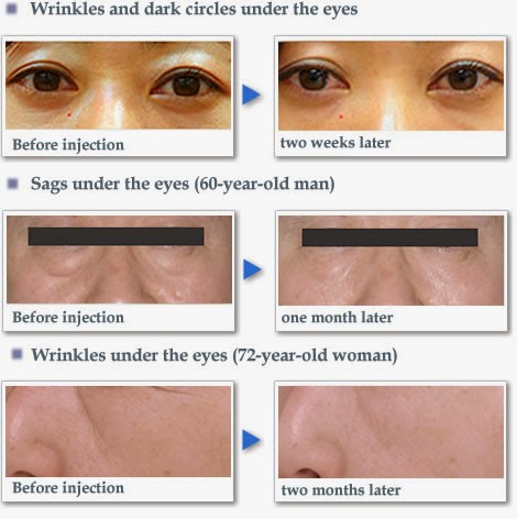 LES INJECTIONS PART 2