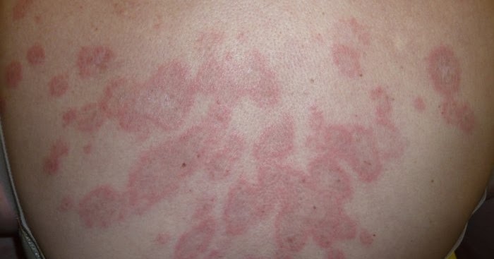 Hanseníase tem cura!: O que é Hanseníase e como se transmite