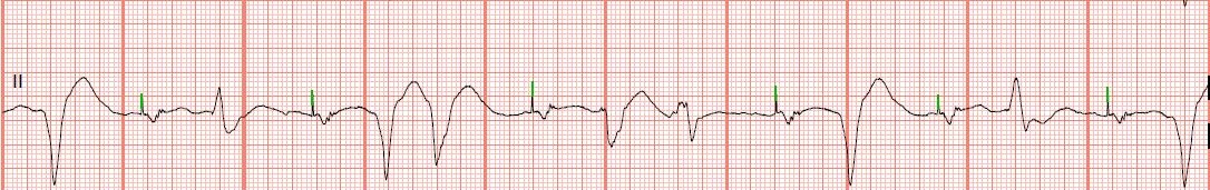ECG Rhythm Strip Quiz 77