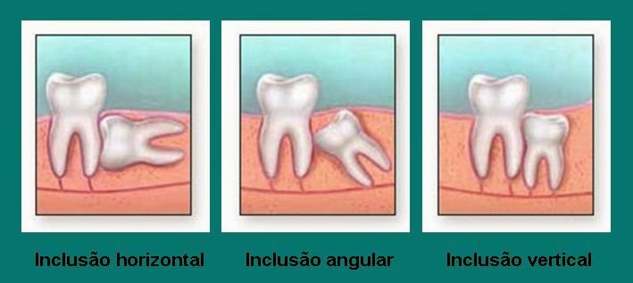 Clinica Dentaria Mais Sorriso: É MESMO NECESSÁRIO EXTRAIR OS 4 SISOS DE ...