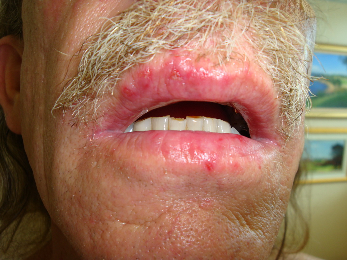 Dermatology For Dentists and Dental Students: Lips