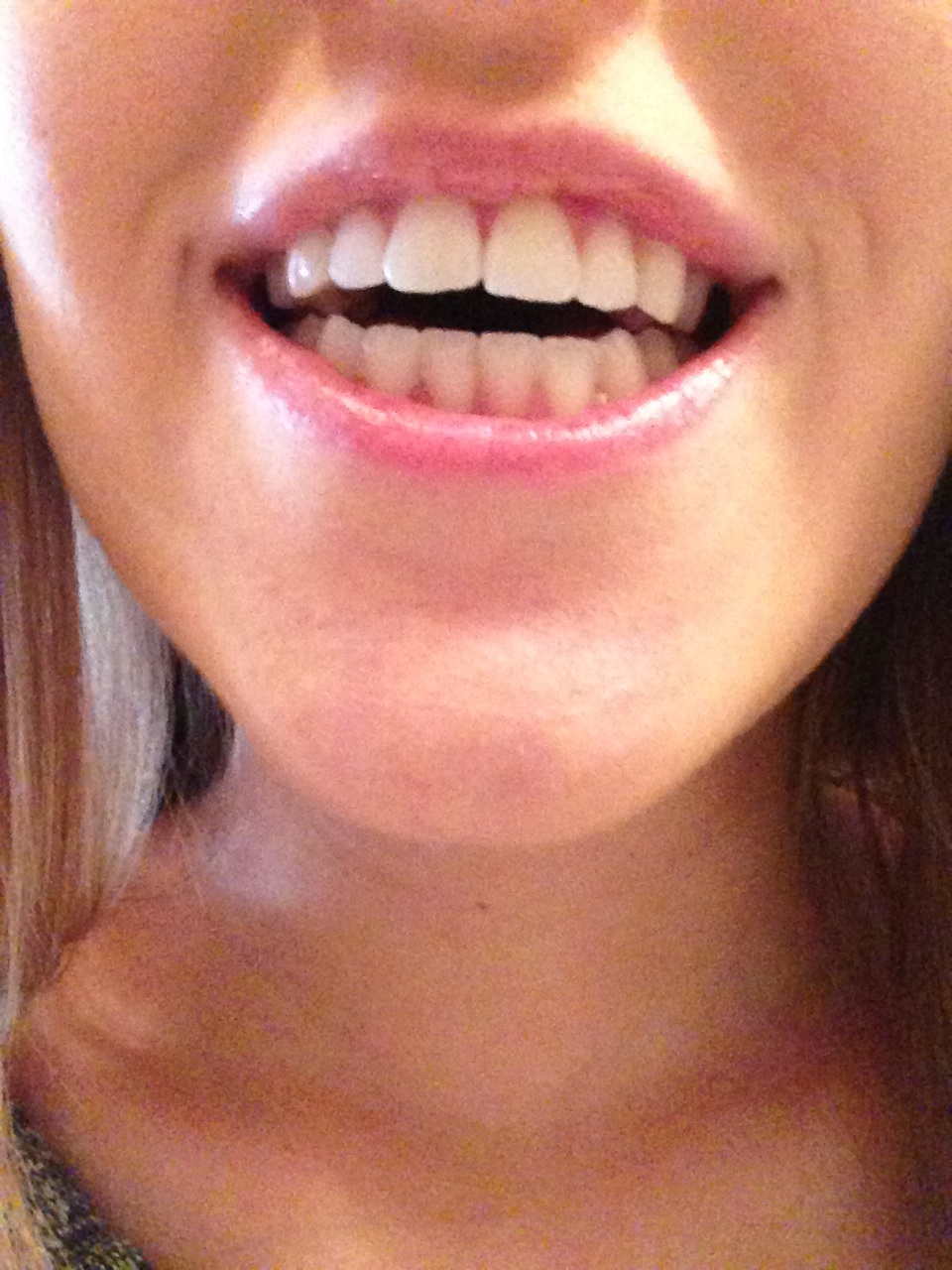 Journey through braces+open bite jaw surgery: May 2013