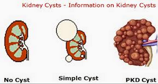 treatment for kidney disease: What Happens When a Kidney (Renal) Cyst ...