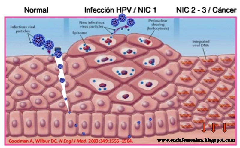 Endofem: Unidad de Endoscopia Ginecológica: 10 hechos acerca del VPH