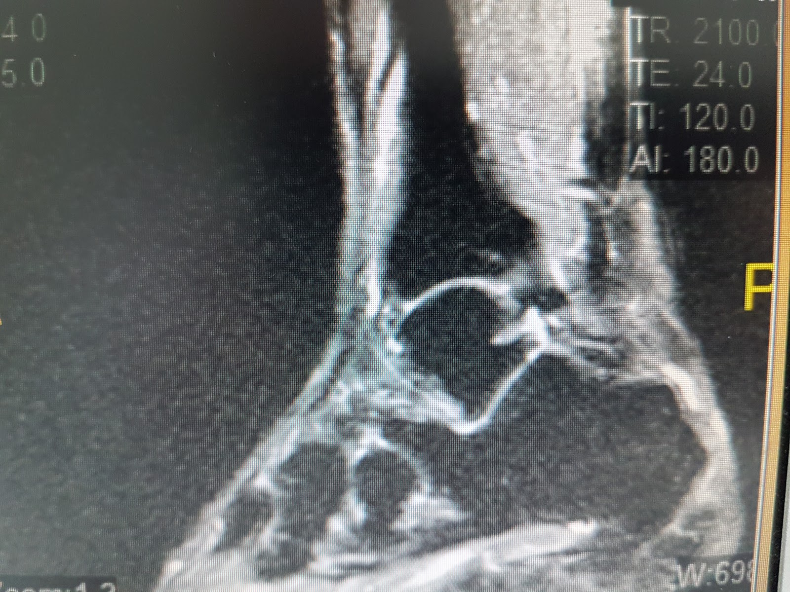 Podo Basas al Día: Fascitis plantar con Topaz. Espolón calcáneo. Rotura ...