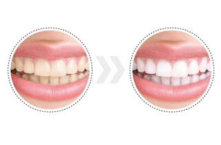 Marlon Becerra Suba: ¿Qué es un Blanqueamiento Dental?