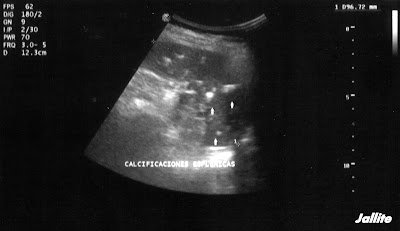Diario de un Medico II: Calcificaciones Esplenicas