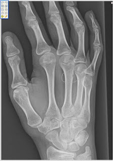 Fibrous Cortical Defect Metacarpal - Sumer's Radiology Blog