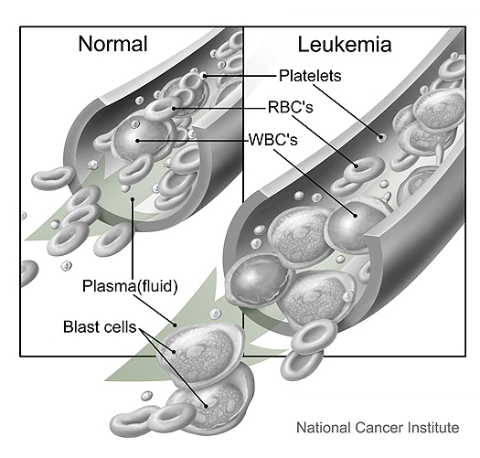 SELF HEALHTY: CARA MENGENAL LEUKIMIA PADA ANAK DAN AKHIBATNYA