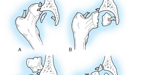 11:50: FRACTURA LUXACIÓN DE CADERA