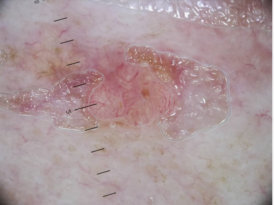 Dermpath Made Simple - Neoplastic: Sebaceous Tumours