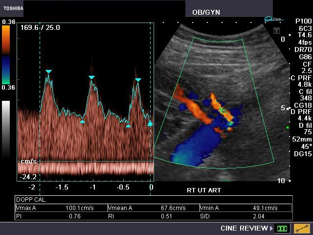 Ultrasound and Color Doppler videos: Color Doppler imaging of the ...