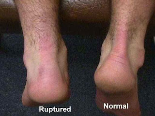 Health And Beauty Tips: Symptoms of Achilles tendon rupture