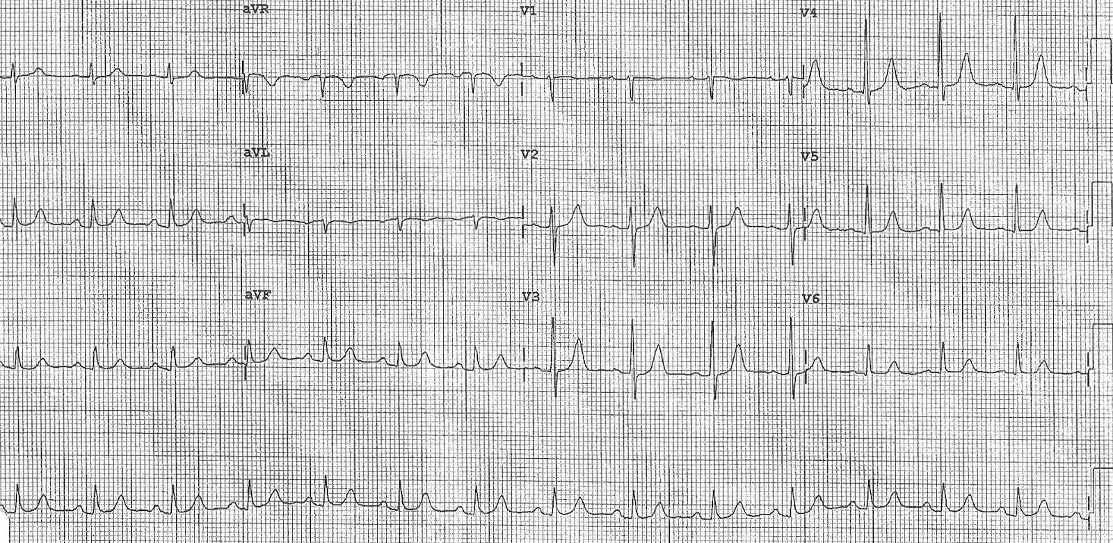 ECG of the Week: ECG of the Week - 18th March 2013 - Interpretation