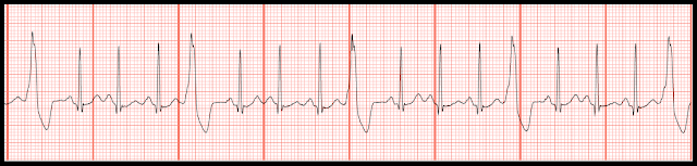 Float Nurse: Various Quadrigeminal PVCs