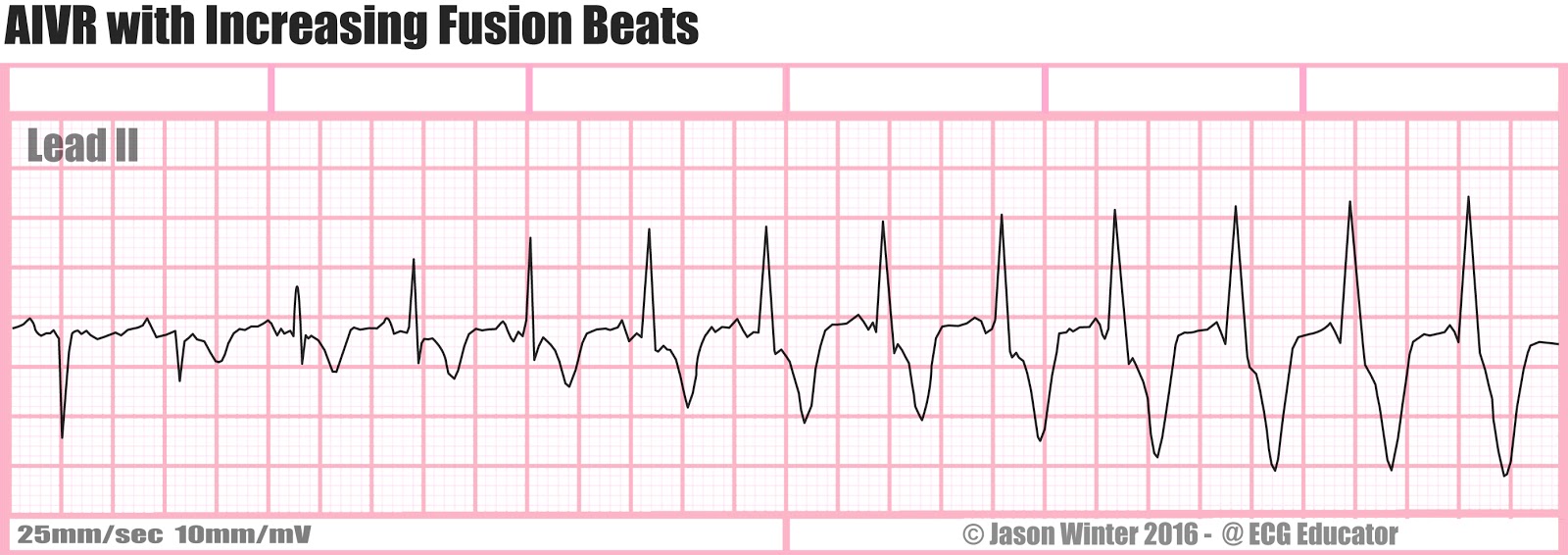 ECG Educator Blog : Six Second ECG Rhythm Strips