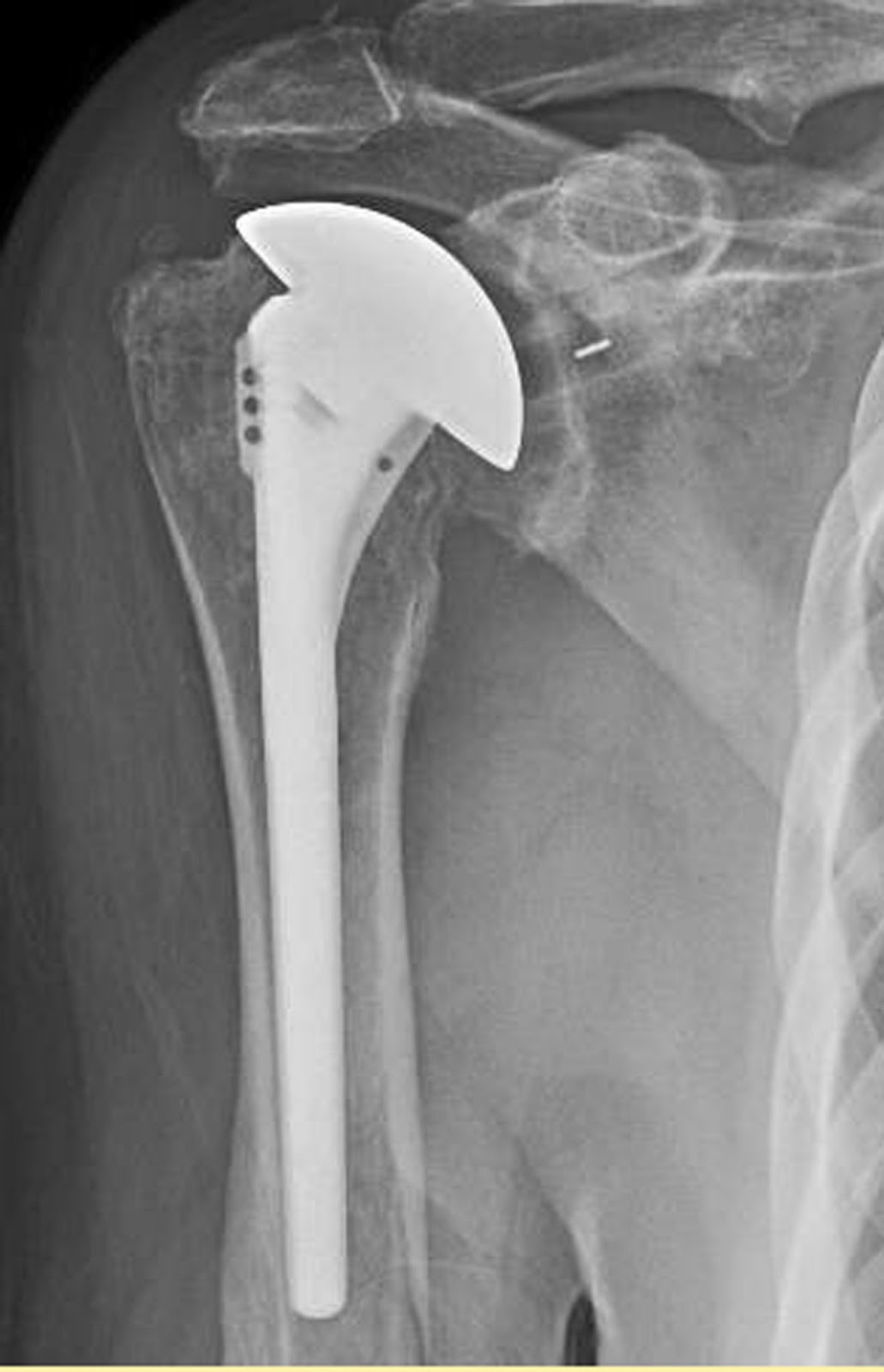 UW Shoulder and Elbow Academy: Total shoulder - tuberosity fracture and ...