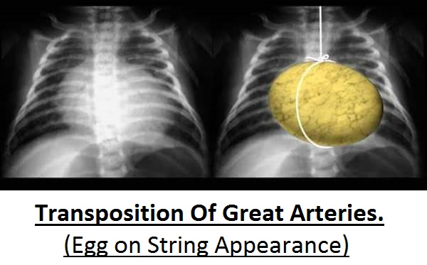 Study Medical Photos: Transposition Of The Great Arteries- A Congenital ...
