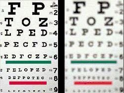 Astigmatismo Causas, Síntomas y Tratamiento ~ El Cuidado de la Salud