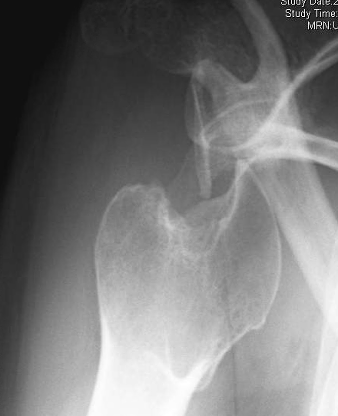 UW Shoulder and Elbow Academy: Shoulder joint replacement - many ...