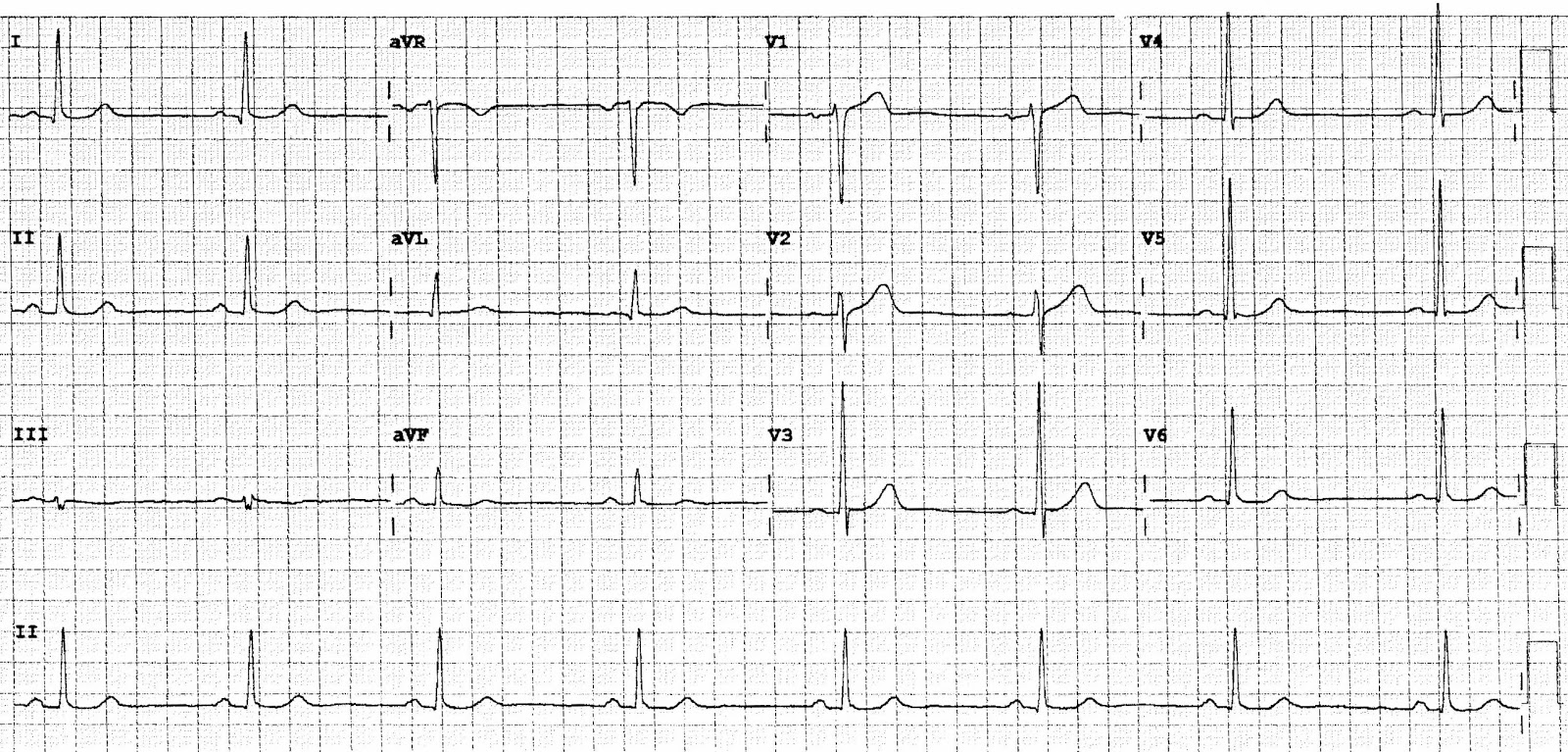 ECG of the Week: ECG of the Week - 23rd April 2018 - Interpretation