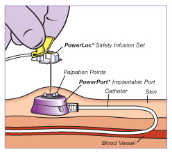 Se on syöpä nyt: Takuuseen meni