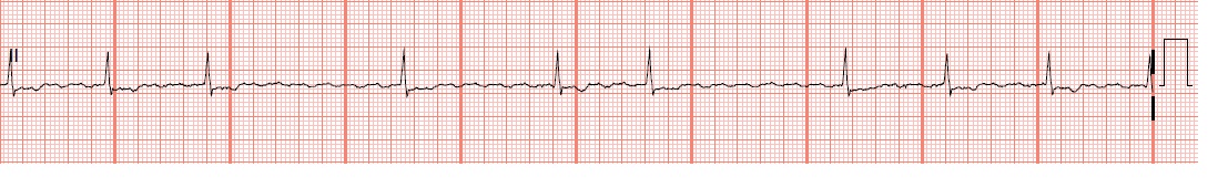 EKG Rhythm Strips 16: Atrial Rhythms