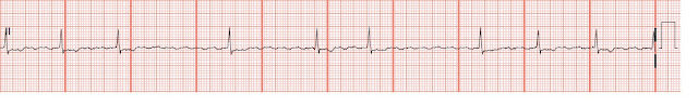 EKG Rhythm Strips 16: Atrial Rhythms
