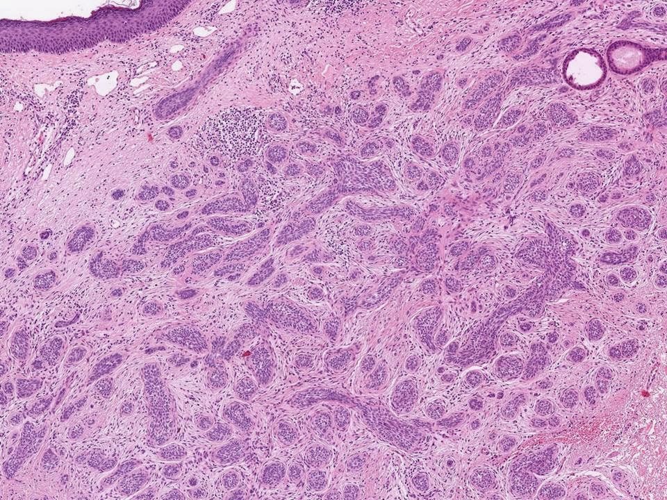 Differential Diagnosis in Dermatopathology: Desmoplasia