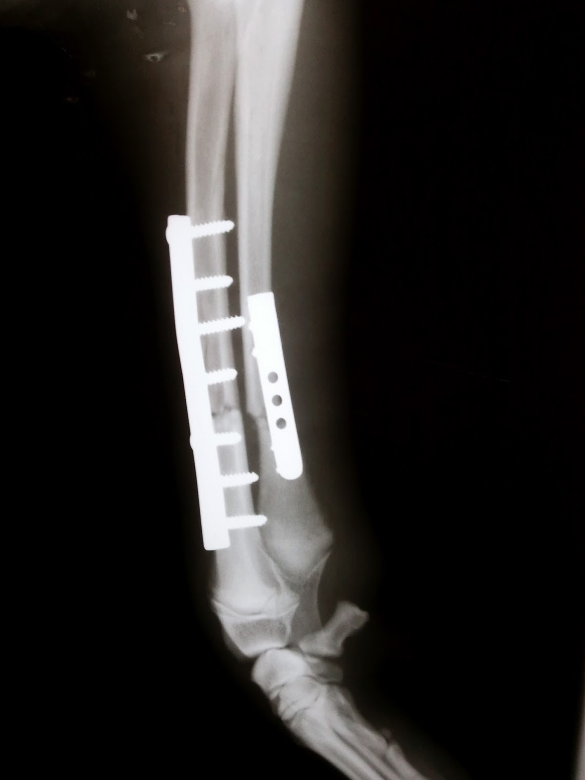 ARTROVET: Fractura de cúbito y radio