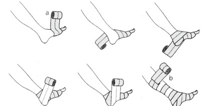 La contention veineuse | Récap' IDE